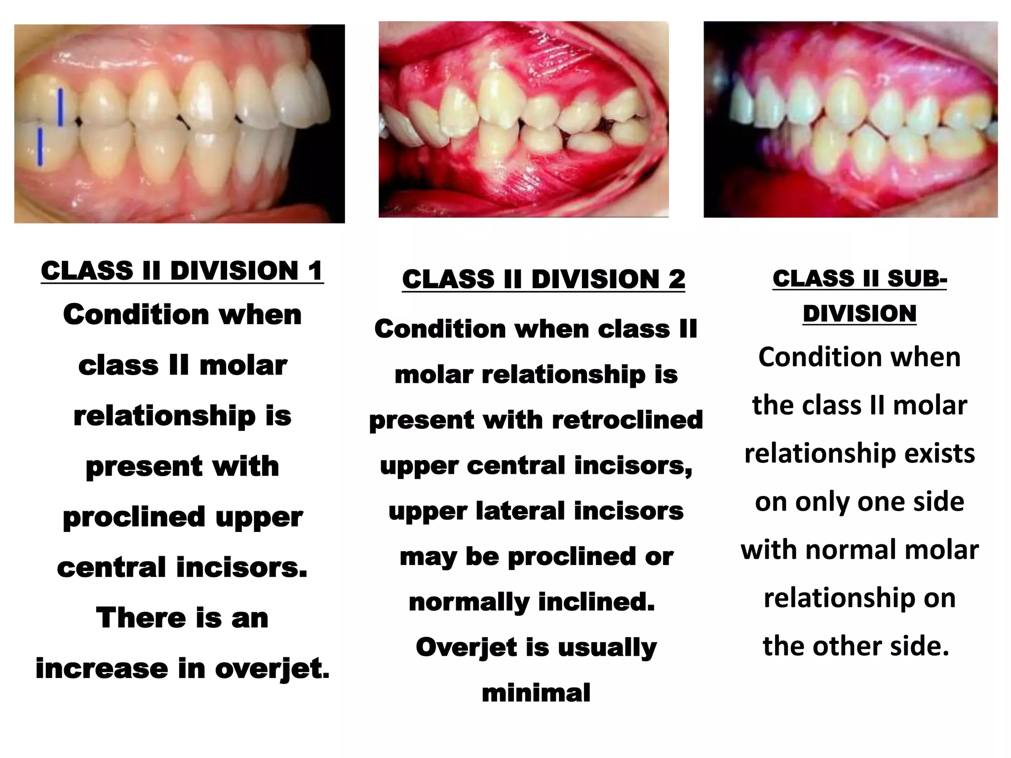 8 - setting of teeth for class I, II and II arch relation ship (Edited ...