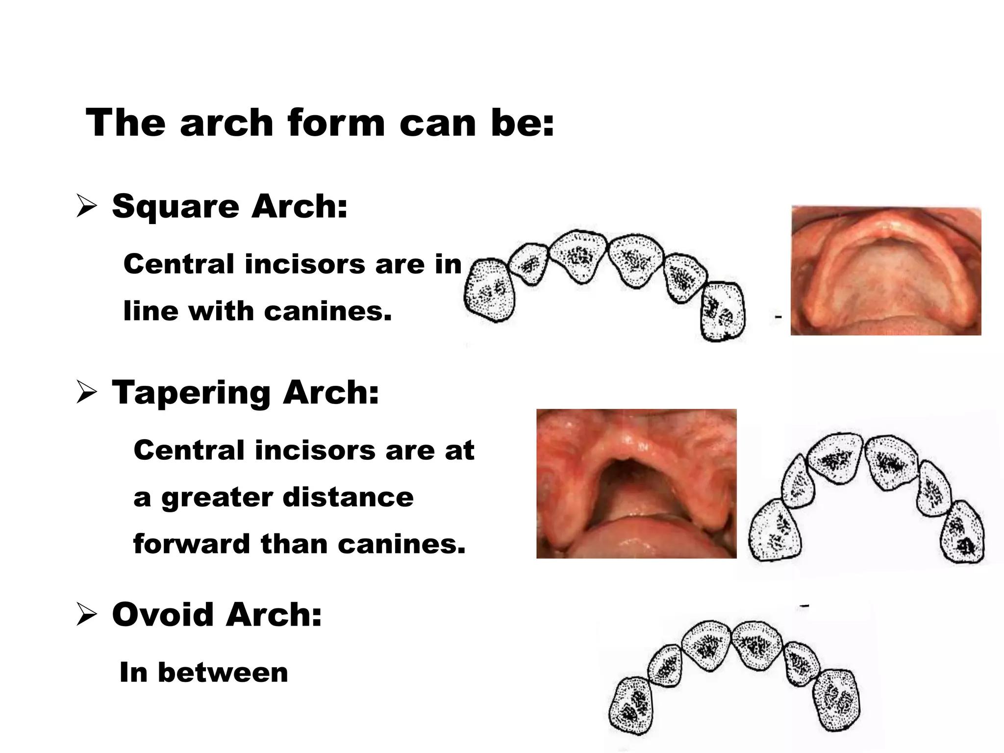 8 - setting of teeth for class I, II and II arch relation ship (Edited ...