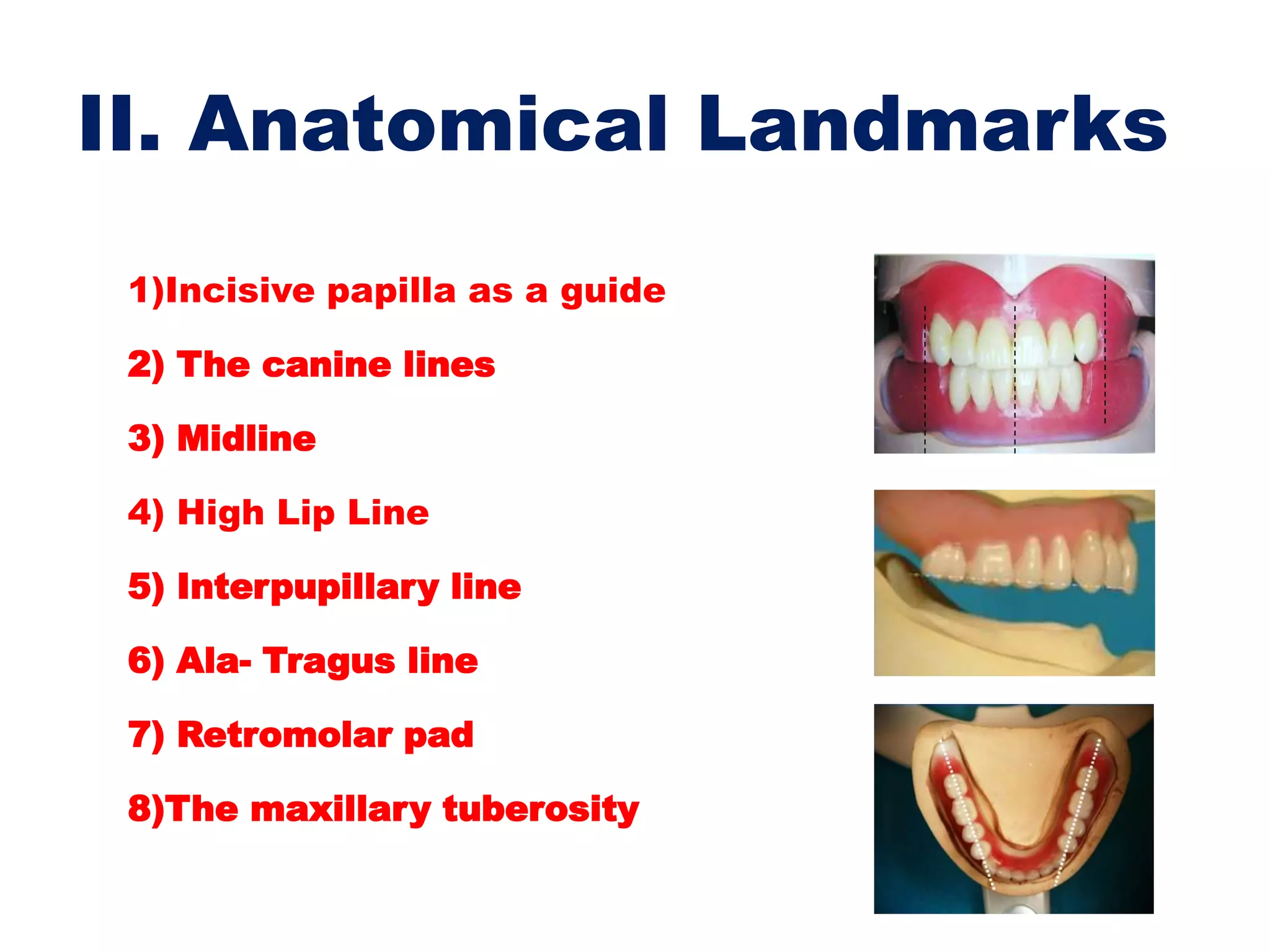 8 - setting of teeth for class I, II and II arch relation ship (Edited ...