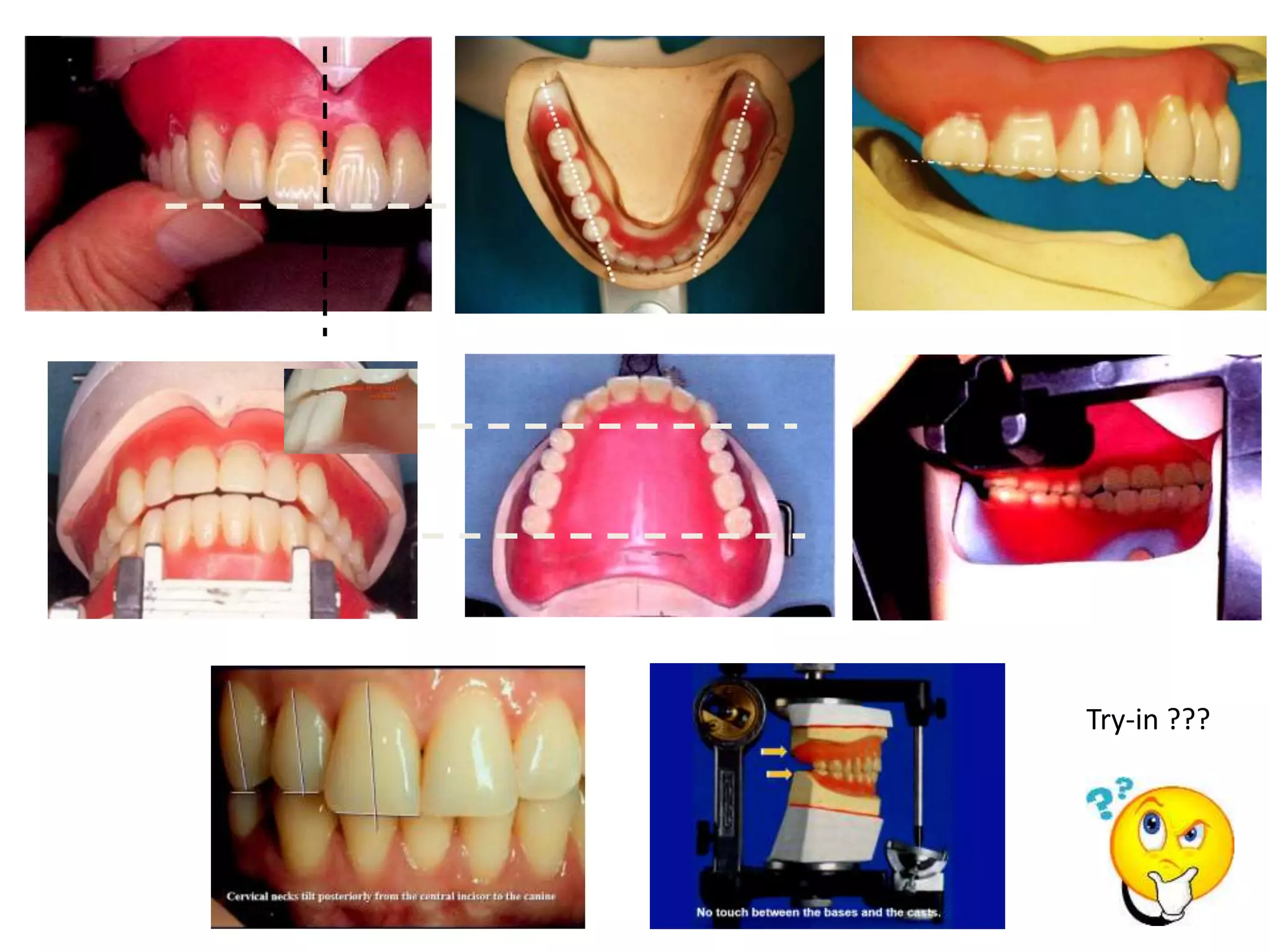 8 - setting of teeth for class I, II and II arch relation ship (Edited ...