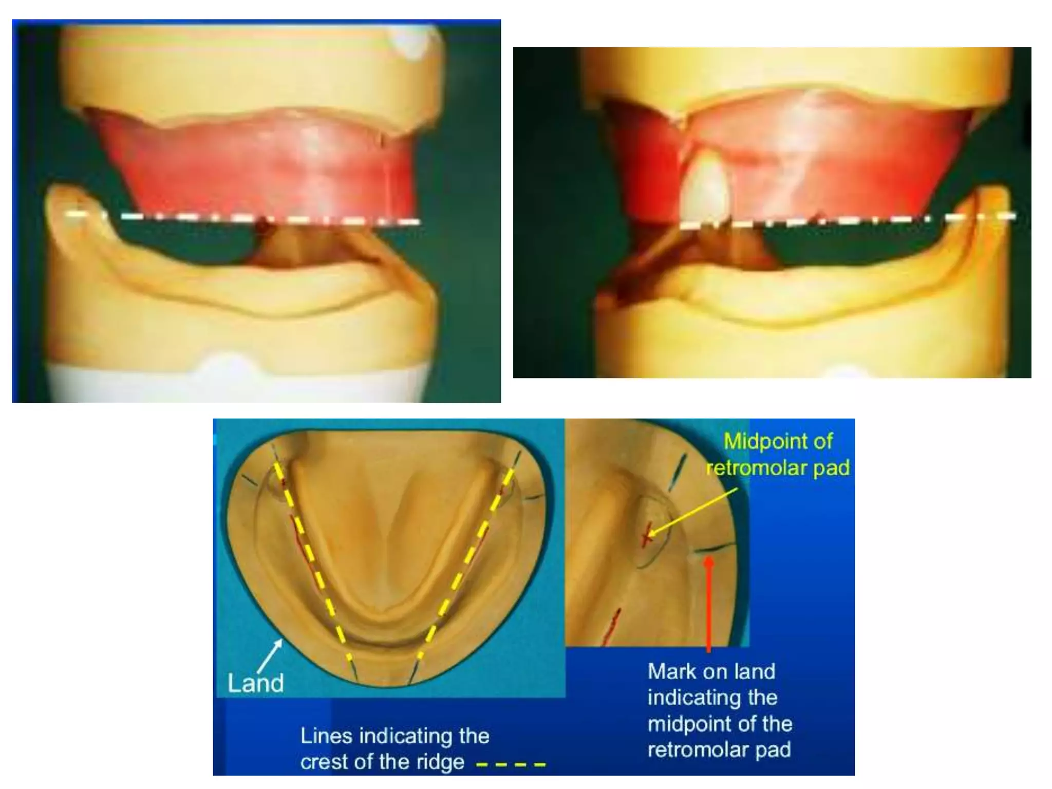 8 - setting of teeth for class I, II and II arch relation ship (Edited ...