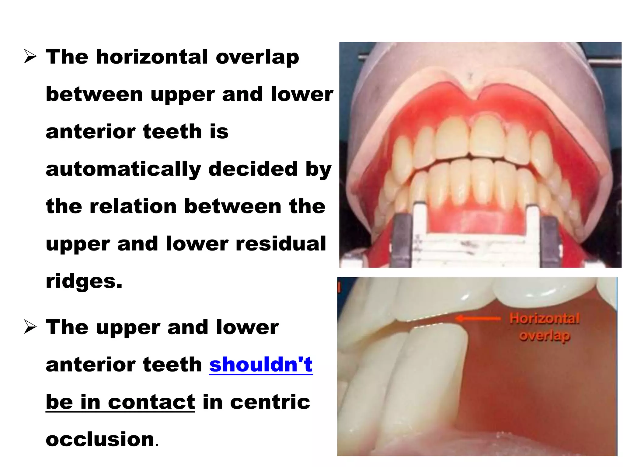 8 - setting of teeth for class I, II and II arch relation ship (Edited ...
