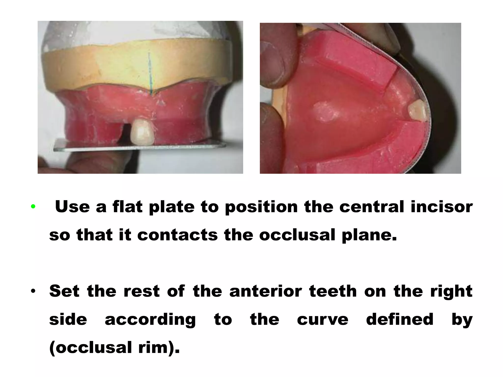 8 - setting of teeth for class I, II and II arch relation ship (Edited ...