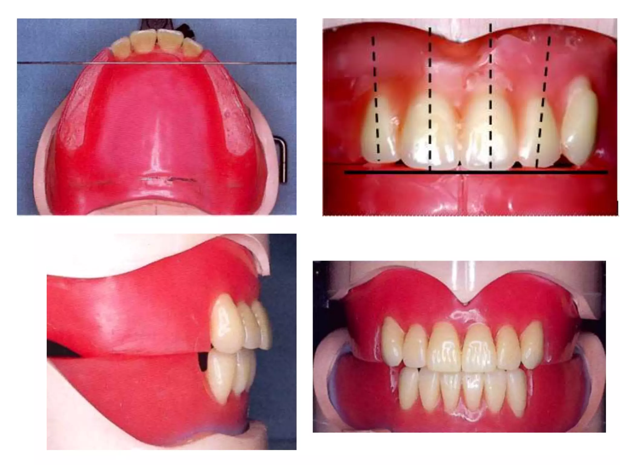 8 - setting of teeth for class I, II and II arch relation ship (Edited ...