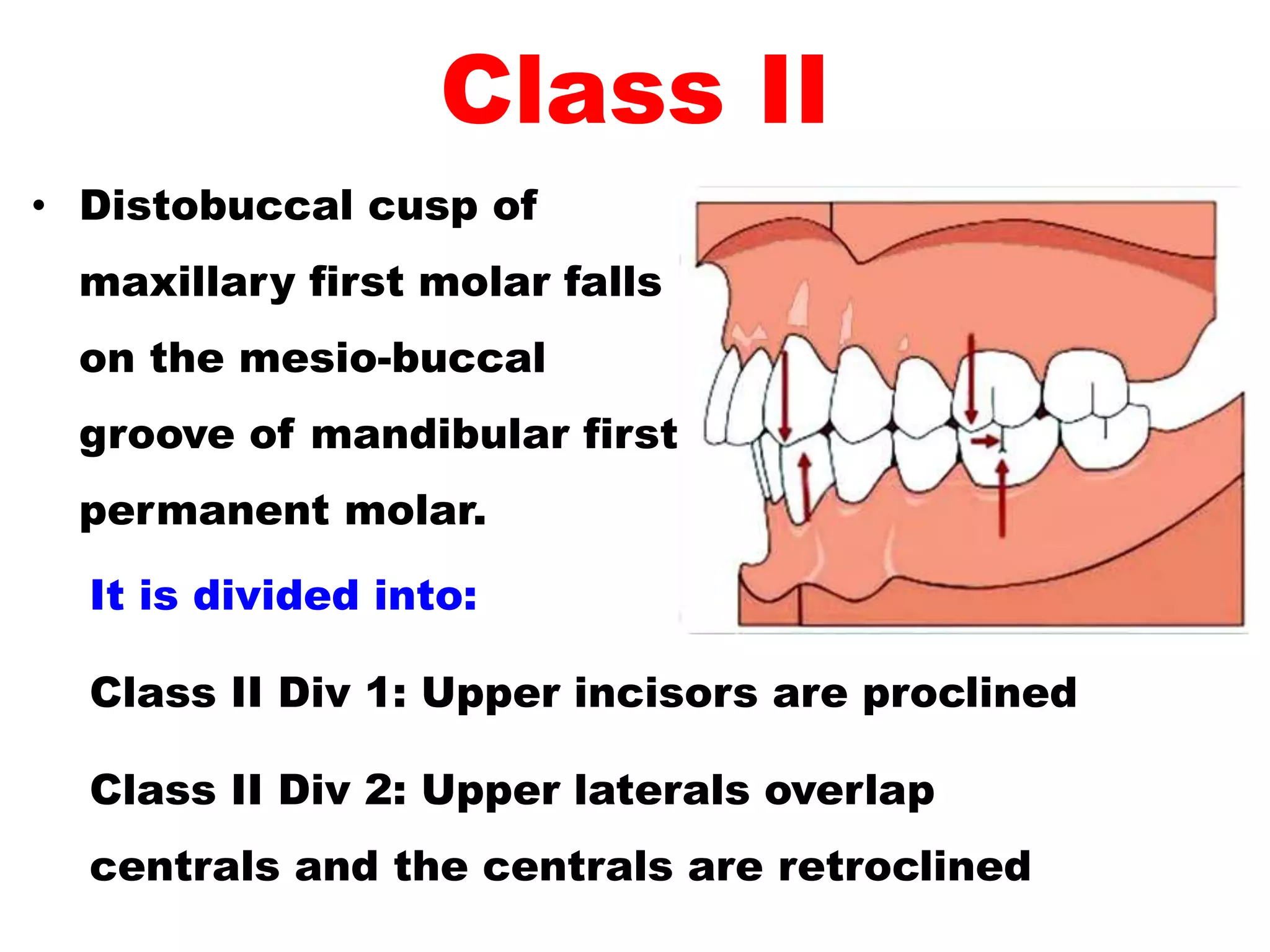 8 - setting of teeth for class I, II and II arch relation ship (Edited ...