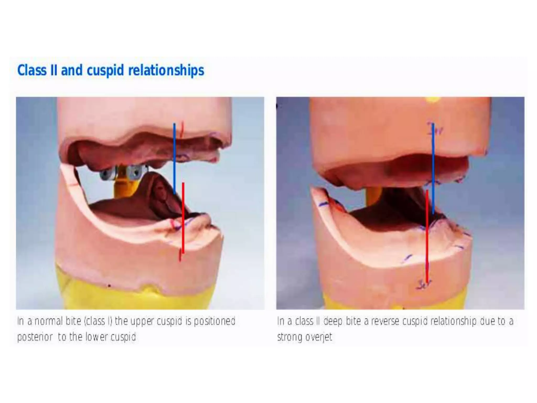 8 - setting of teeth for class I, II and II arch relation ship (Edited ...