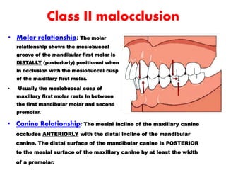 8 - setting of teeth for class I, II and II arch relation ship (Edited ...