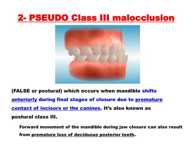 8 - setting of teeth for class I, II and II arch relation ship (Edited ...