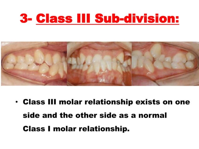 8 - setting of teeth for class I, II and II arch relation ship (Edited ...
