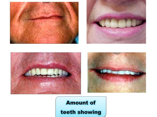 8 - setting of teeth for class I, II and II arch relation ship (Edited ...
