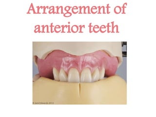 8 - setting of teeth for class I, II and II arch relation ship (Edited ...