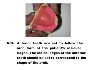 8 - setting of teeth for class I, II and II arch relation ship (Edited ...