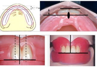 8 - setting of teeth for class I, II and II arch relation ship (Edited ...