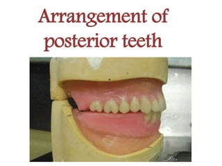 8 - setting of teeth for class I, II and II arch relation ship (Edited ...