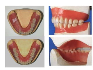 8 - setting of teeth for class I, II and II arch relation ship (Edited ...