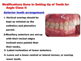 8 - setting of teeth for class I, II and II arch relation ship (Edited ...