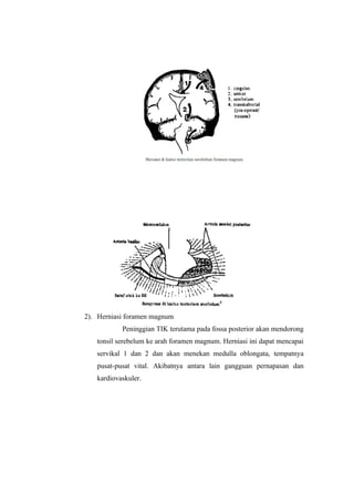 80051025 edema-serebri | PDF