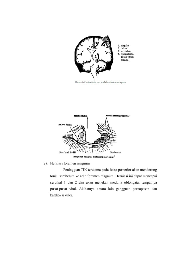 80051025 edema-serebri | PDF