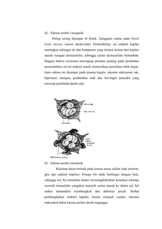 80051025 edema-serebri | PDF
