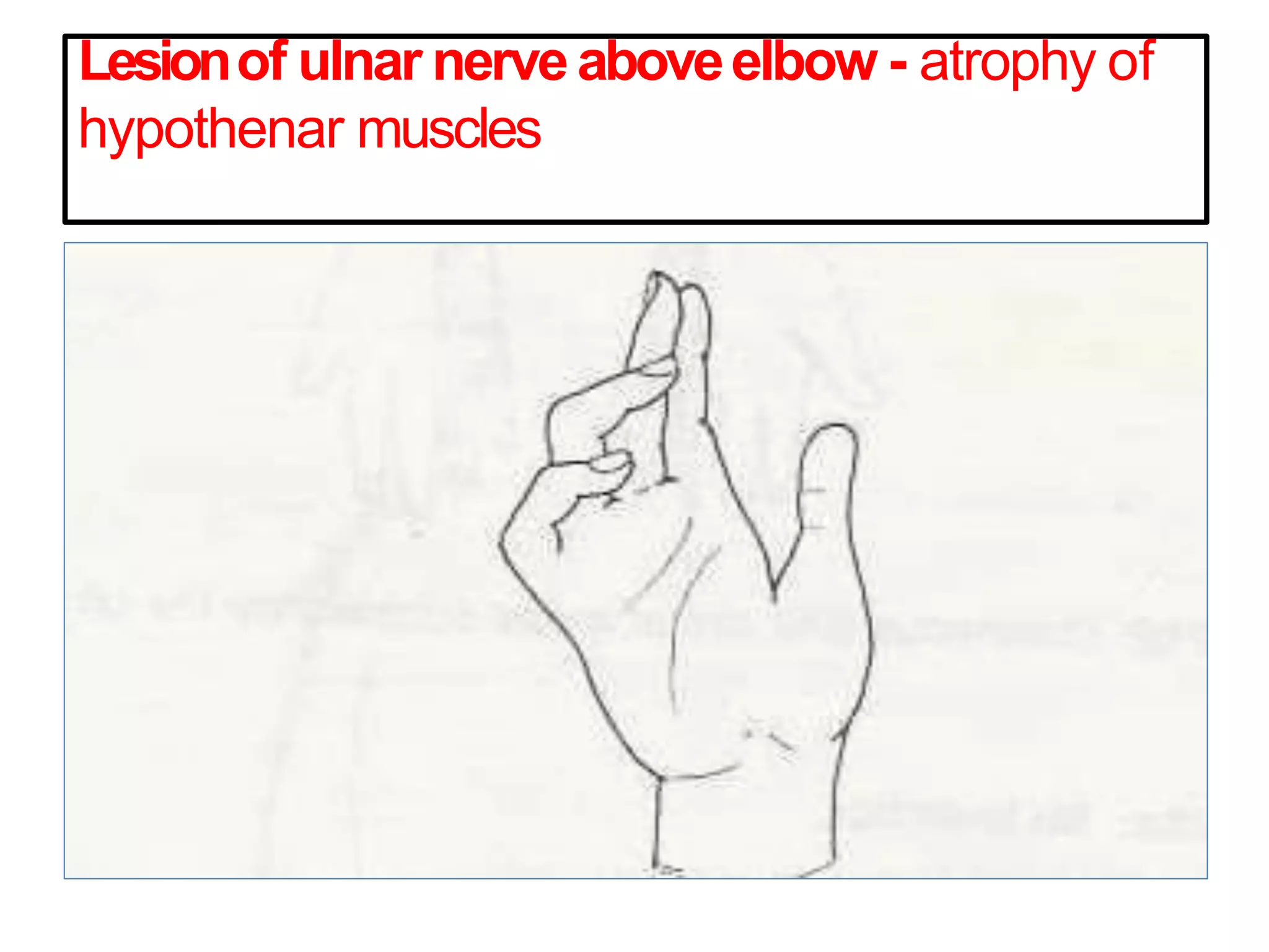 807_Ulnar-nerve-and-its-lesions.pptx