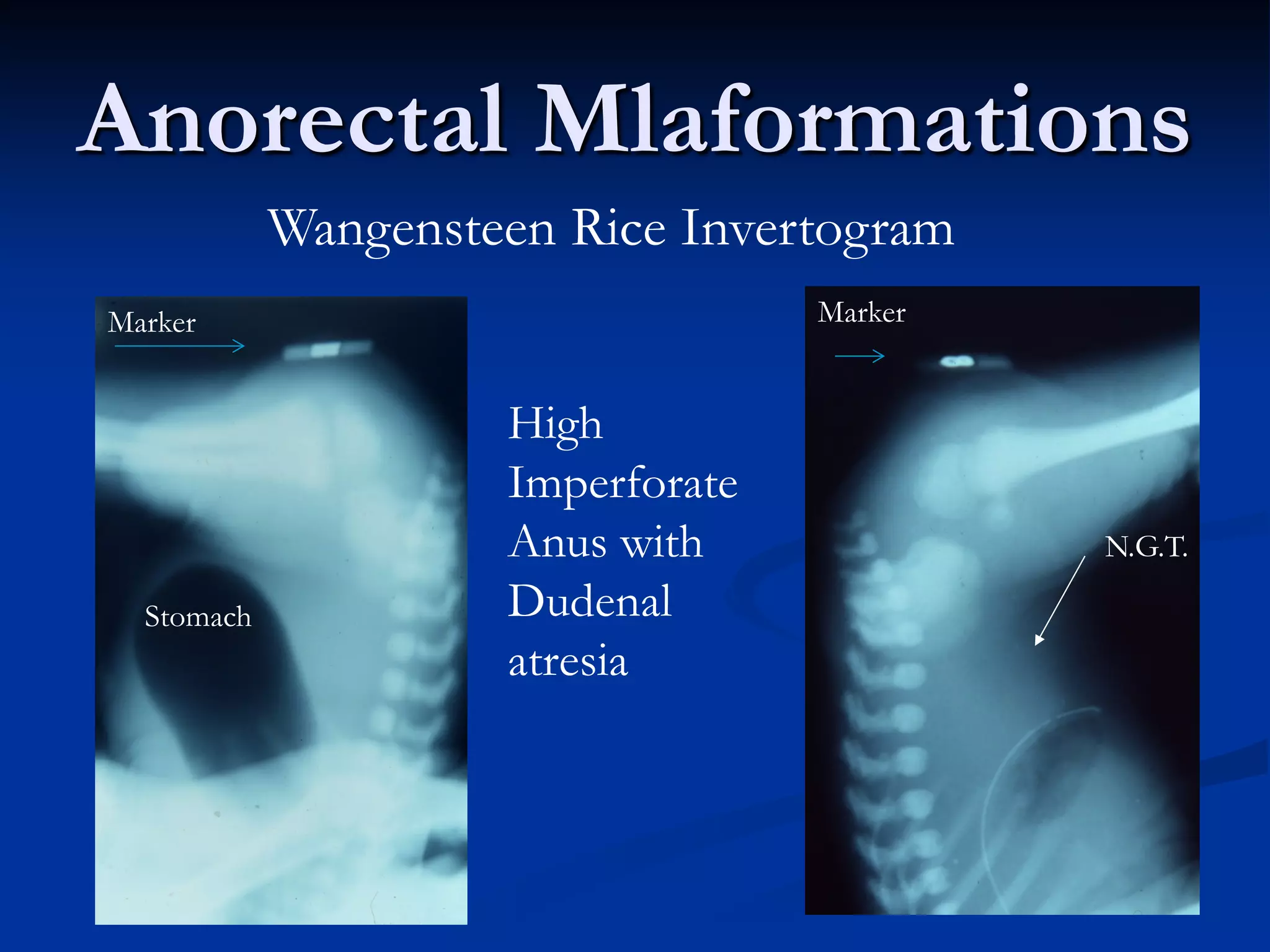 anorectal malformation | PDF