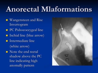 anorectal malformation | PPT