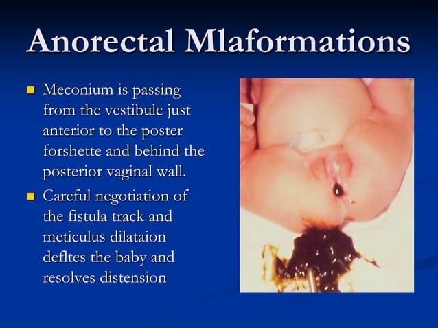 Anorectal Malformation Ppt