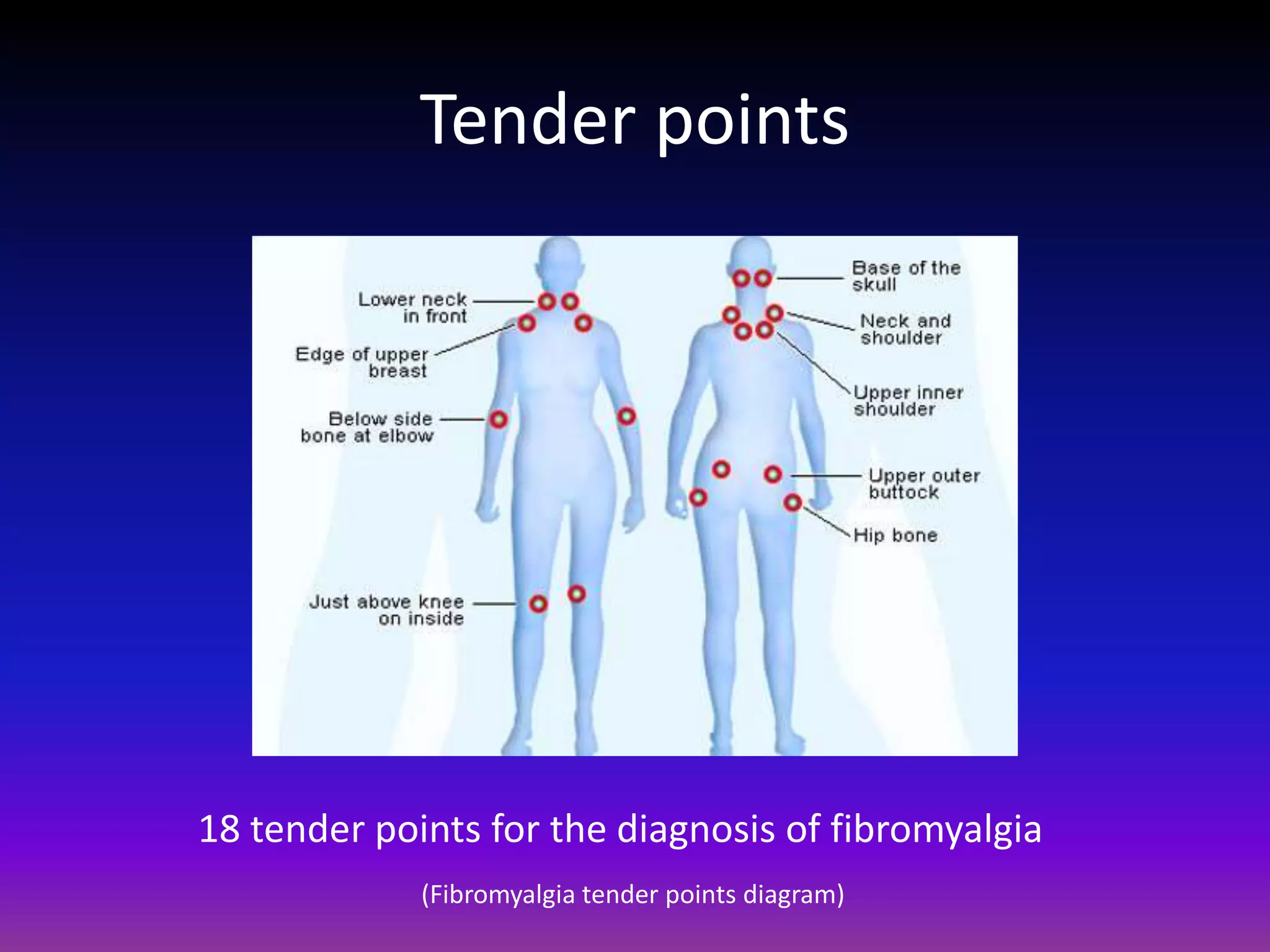 Fibromyalgia powerpoint completed | PPTX