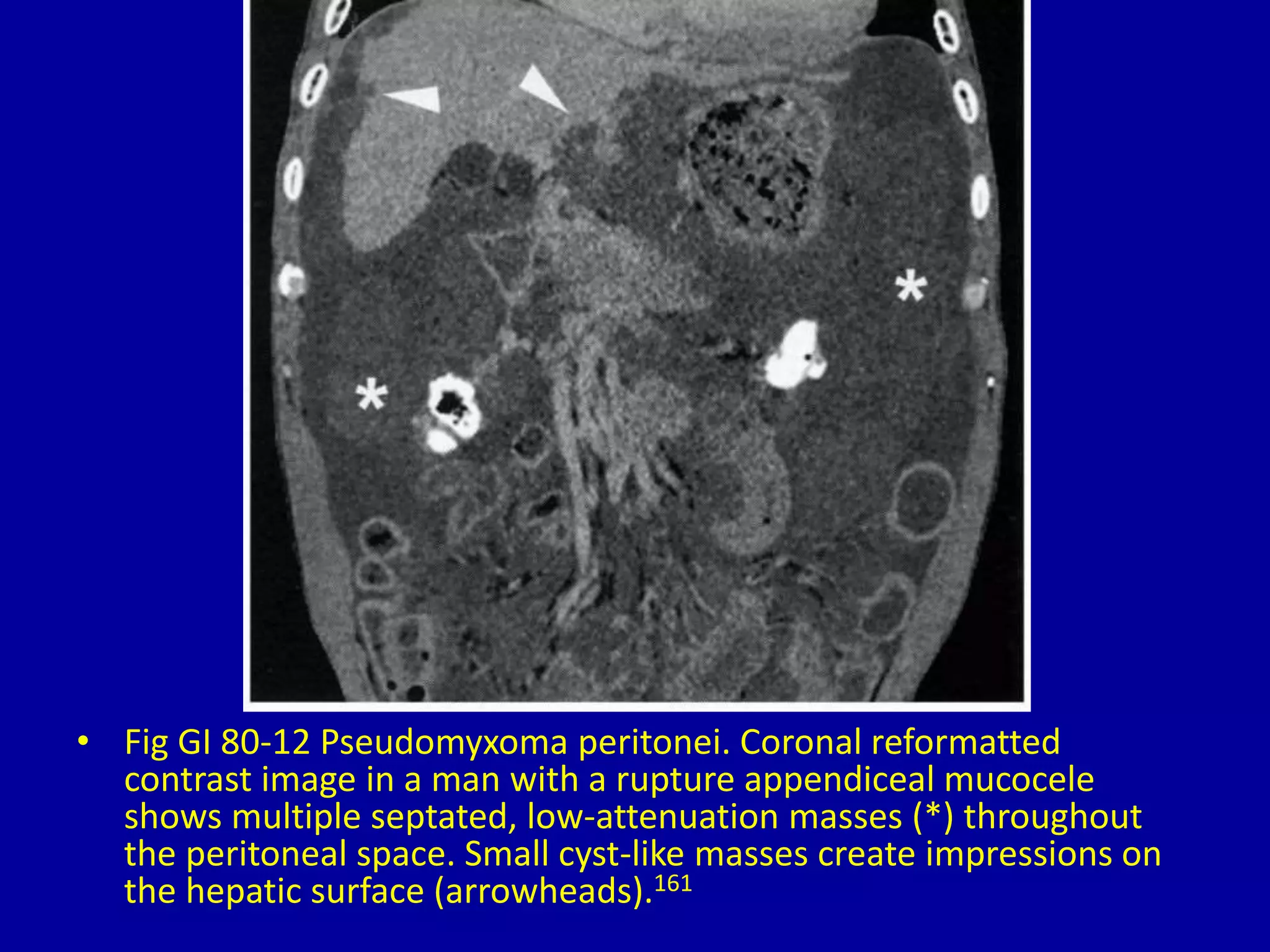 80 perihepatic space | PPT