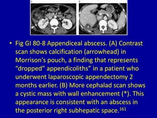80 perihepatic space | PPT
