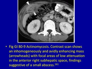 80 perihepatic space | PPT
