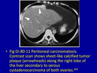 80 perihepatic space | PPT
