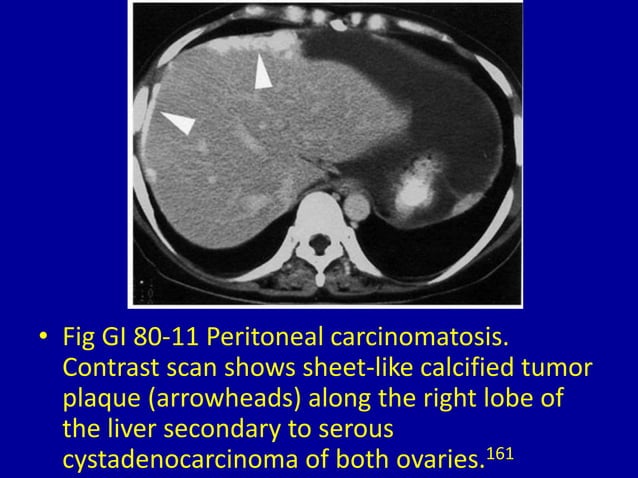 80 perihepatic space | PPT