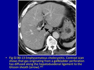 80 perihepatic space | PPT