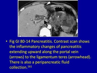 80 perihepatic space | PPT
