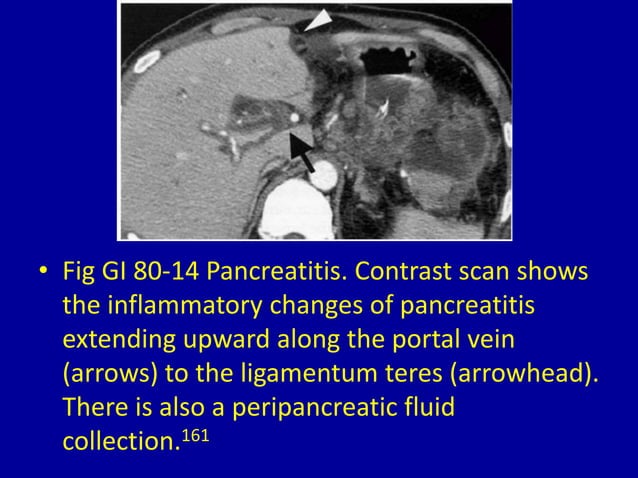 80 perihepatic space | PPT