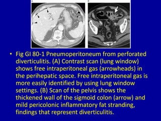 80 perihepatic space | PPT