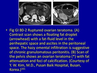 80 perihepatic space | PPT