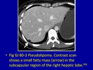 80 perihepatic space | PPT