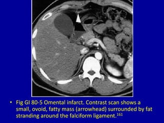 80 perihepatic space | PPT