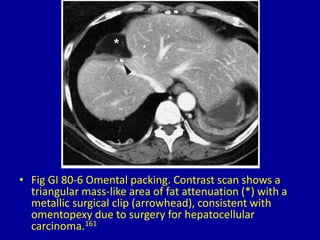 80 perihepatic space | PPT
