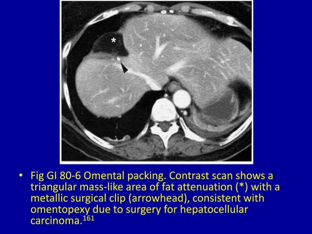 80 perihepatic space | PPT