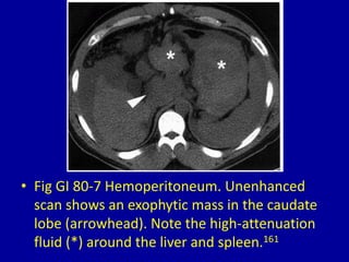 80 perihepatic space | PPT