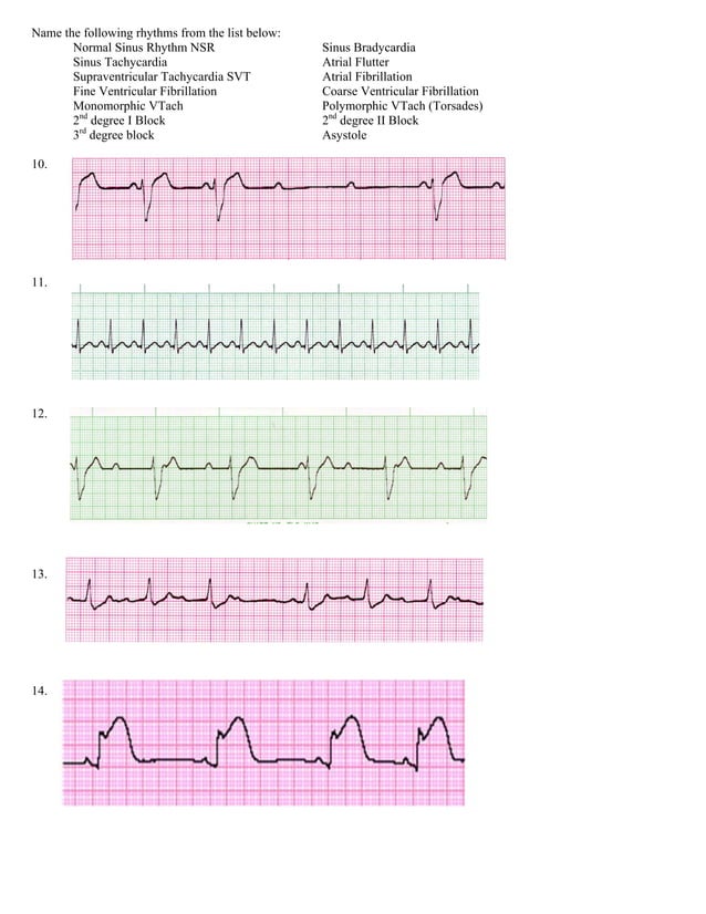 ECG FOR acls | PDF