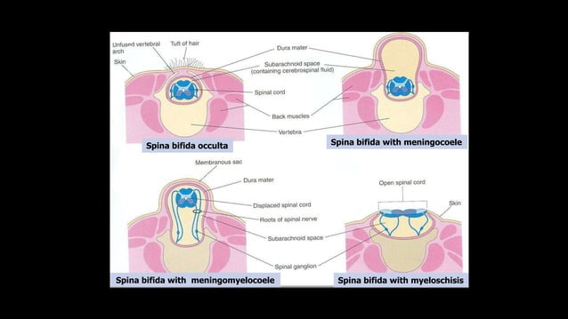Embryology and Development of Spinal Dysraphism and Tethered Spinal ...