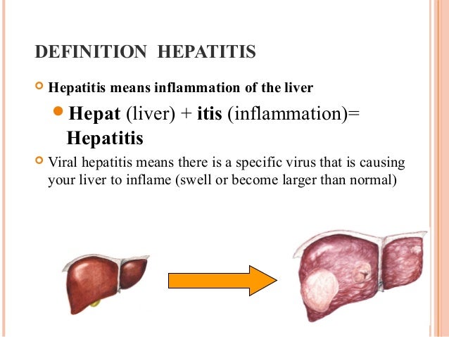 infectious hepatitis