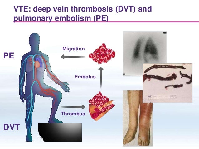 DVT Presentation1 preview