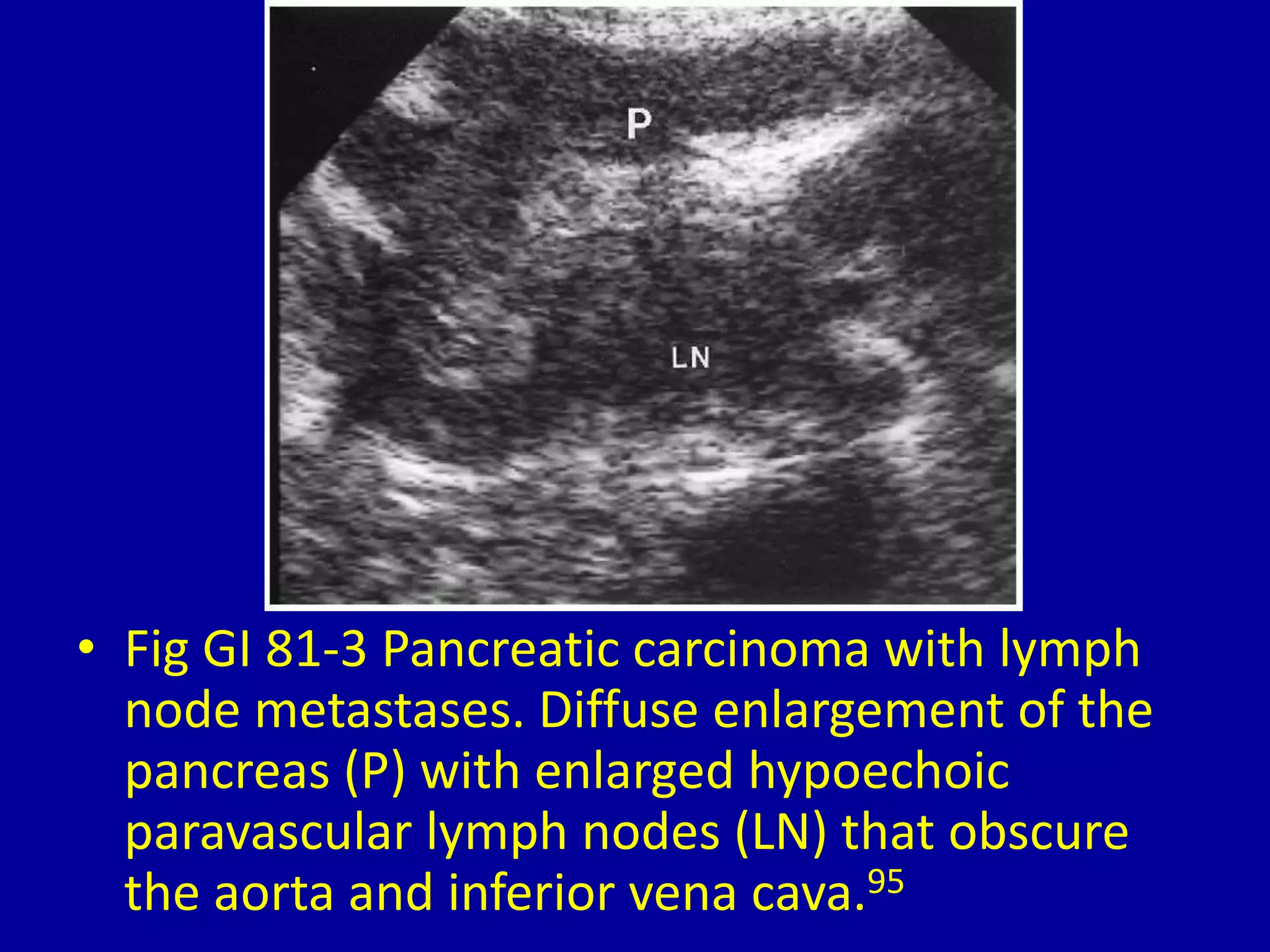 81 pancreatic masses on the ultrasound | PPTX