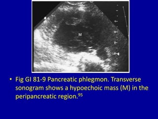 81 pancreatic masses on the ultrasound | PPTX