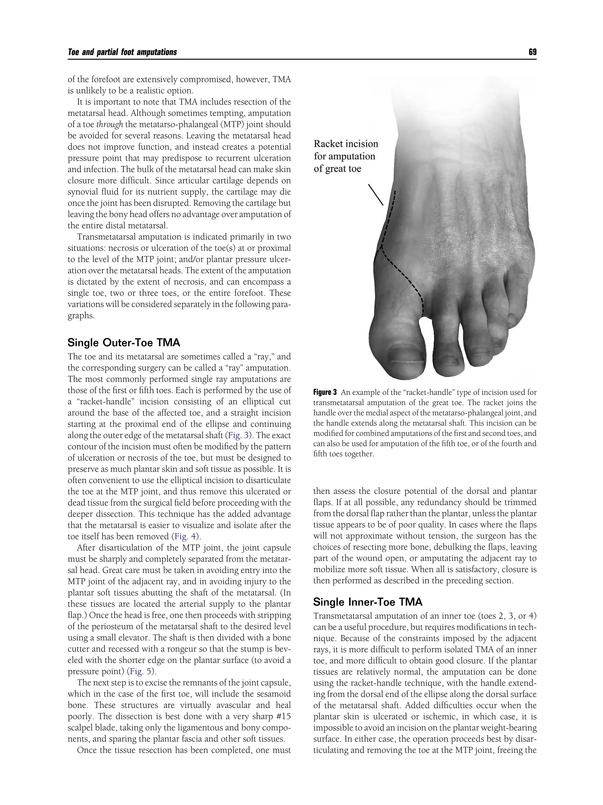 Toe and Partial Foot Amputations | PDF
